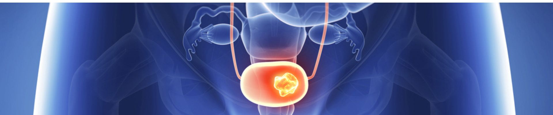 Καρκίνος ουροδόχου κύστης | Κατηγορίες & θεραπεία